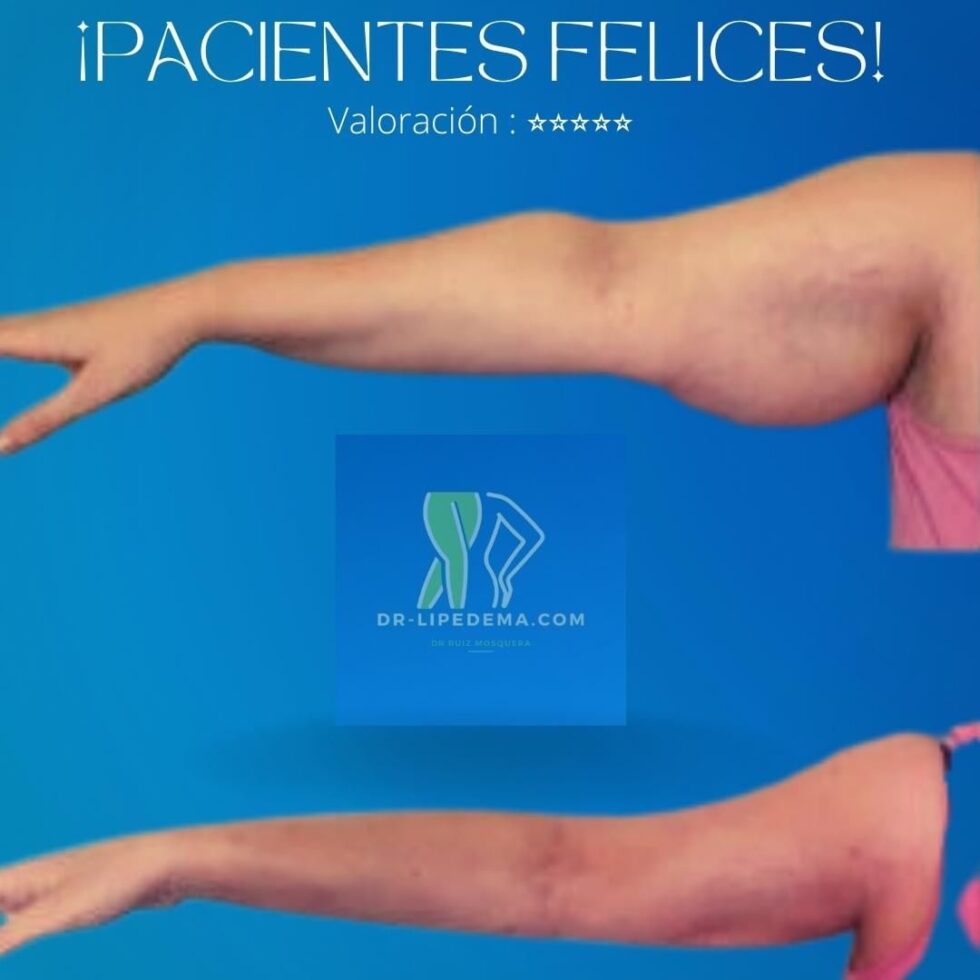 Lipedema brazos - Dr Lipedema